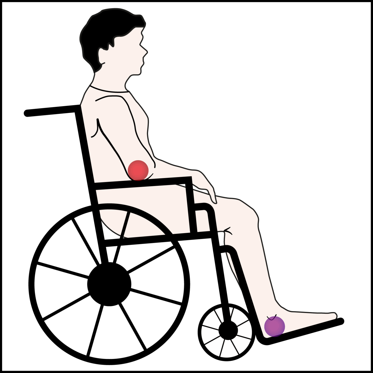 An easy read guide to pressure sores - Digital patient information hub