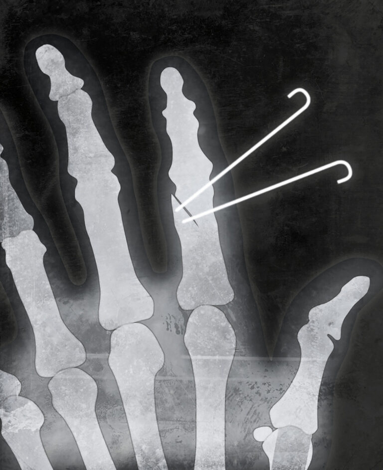Kirschner Wire (K wire) Fixation for Fractures in the Hand - Digital ...