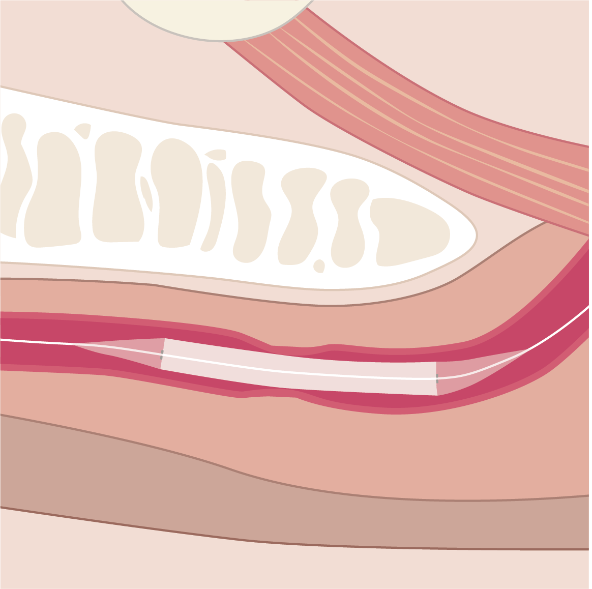 Anterior Urethral Strictures - Digital patient information hub